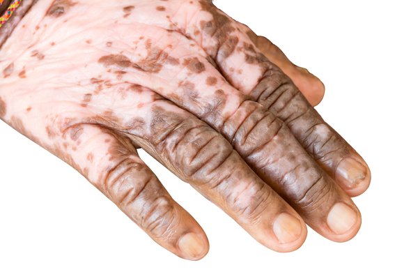 Vitiligo Surgery - Apex Clinic - Dr. Rajesh Rathi