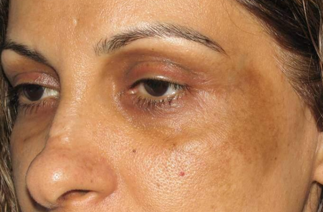 Pigmentation - Apex Clinic - Dr. Rajesh Rathi